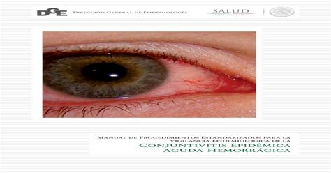 Conjuntivitis Epidémica Aguda Hemorrágica187 191 75 115 Gobmx Salud