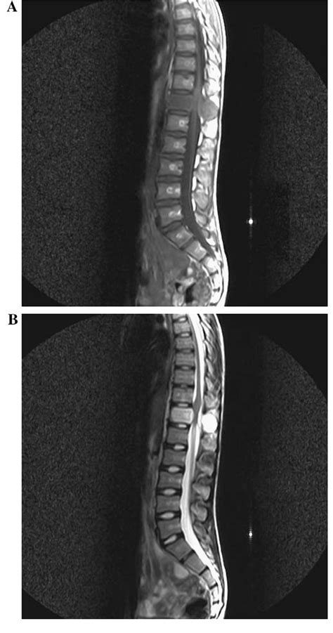Figure 1 From Clinical And Imaging Findings In Patients With Aggressive