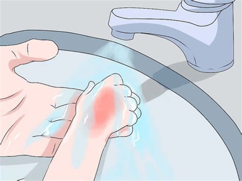 Sơ Cứu Khi Bị Bỏng Lửa Bỏng Nước Sôi Vinmec
