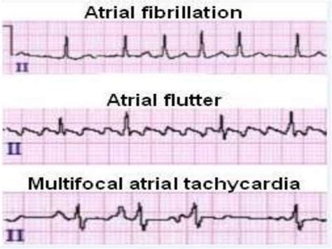 aflutter vs afib atrial flutter litfl ecg library diagnosis the two