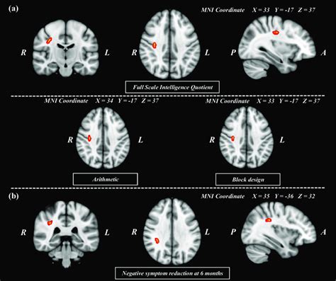 Regions Showing Positive Correlation Between Fractional Anisotropy