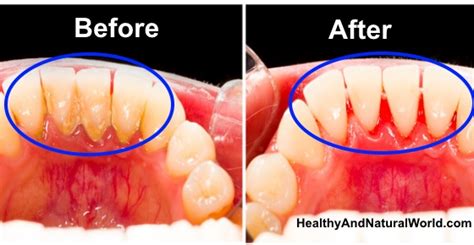 how to remove plaque the natural way