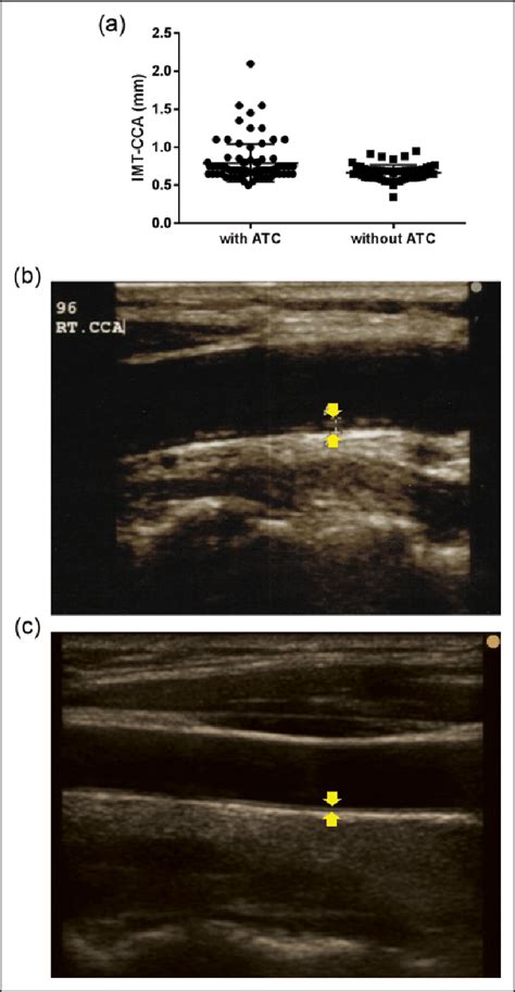 A Intima Media Thickness Of The Common Carotid Artery Imt Cca Mm Of