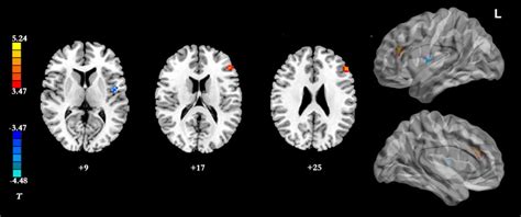 Frontiers Alterations Of Resting State Static And Dynamic Functional