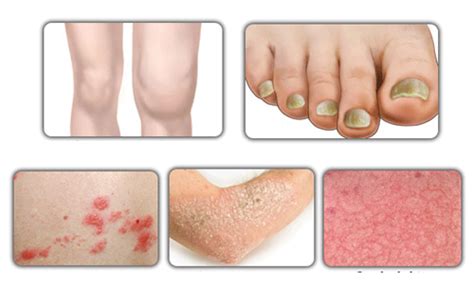 Know The Signs And Symptoms Of Psoriasis To Get Proper Treatment