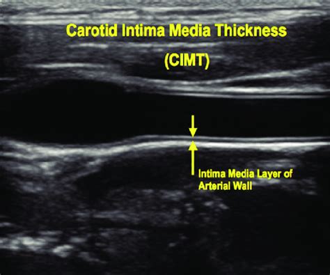 Intima Media Layer Imt Of The Carotid Artery As Seen On Longitudinal