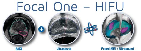 Focal One Hifu Nonivasive Robotic Treatment Of Prostatic Cancer