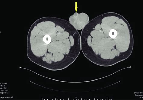Computed Tomography Ct Scan Showing The Scrotal Cyst Along The
