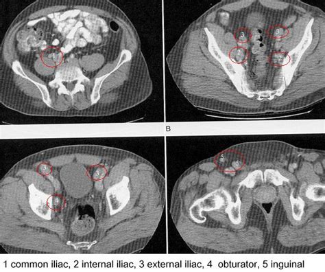 Pelvic Lymph Nodes Anatomy Ct Human Anatomy