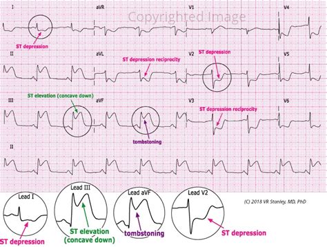Acute Inferior Stemi Dr Stanley S Ecgcourse Dr Stanley S 11312 Hot