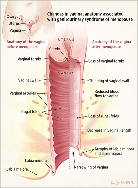vaginal and urinary symptoms of menopause patient information jama