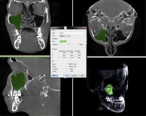 3d Volume Reconstruction Of The Maxillary Sinus Download Scientific