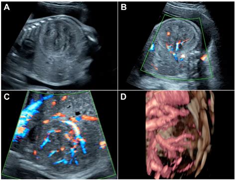 Diagnostics Free Full Text Prenatal Course And Sonographic Features