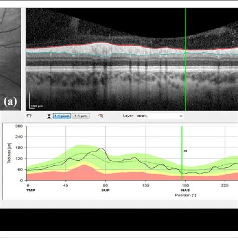 automatic segmentation of the retina for measurement of retinal layers