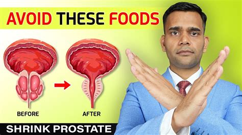 Avoid These Food To Shrink Enlarged Prostate Foods To Avoid To Have