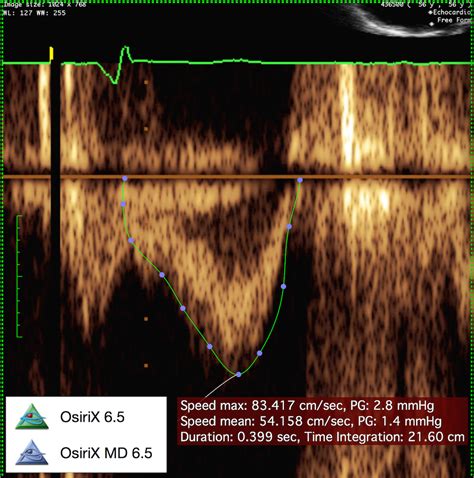 osirix dicom viewer osirix 6 5 release