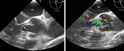 A The Intimal Flap Is Passing Into The Left Ventricle Through The