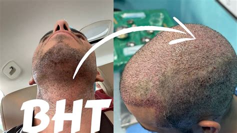 Everything You Need To Know About Bht Beard Hair Transplants Youtube