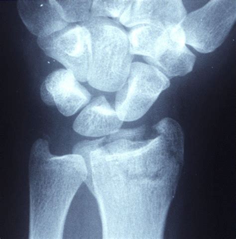 File Displaced Distal Radius Fracture  Wikipedia