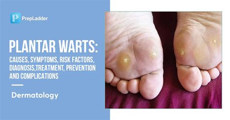 Plantar Warts Causes Symptoms Risk Factors Diagnosis Treatment