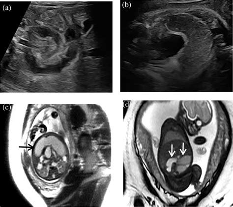 Prenatal Diagnosis Of Midgut Volvulus With Jejunal Atresia By