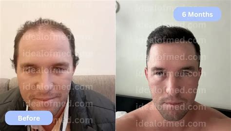 Hair Transplant Results After 6 Months Progress And Images