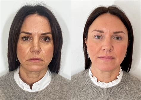 Fillers Before And After The Cosmetic Skin Clinic