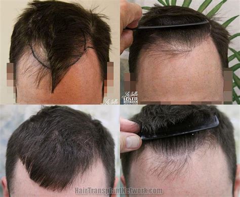 Dr Timothy Carman Hair Transplant Surgery And Scar Revision Before And
