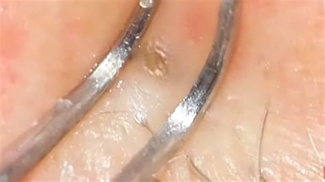 Big Blackhead Removal On Lips Youtube
