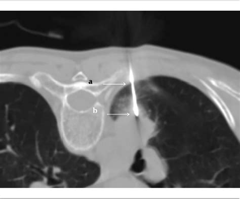 Figure 1 From Ct Guided Percutaneous Core Needle Biopsy For Lung