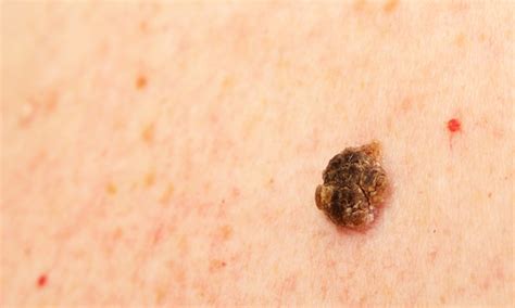 Is There A Way To Treat Seborrheic Keratosis Harvard Health