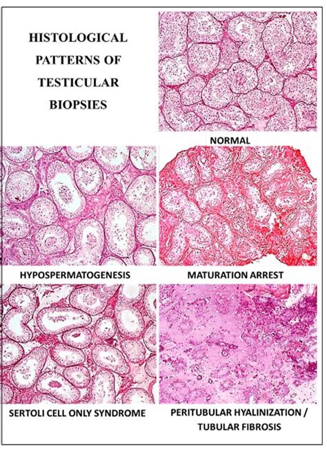 Morphological Features Of Testicular Biopsies In Infertile Males At A