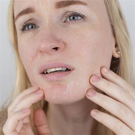 Medical Term For Dry Skin Definitions And References Dry Skin Love