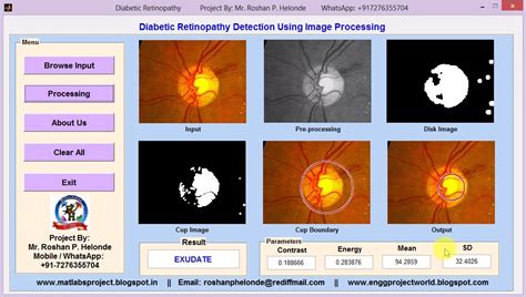 diabetic retinopathy detection using image processing full matlab