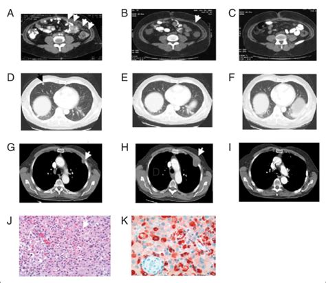 Examples Of Tumor Responses Computed Tomography Ct Scans Of The