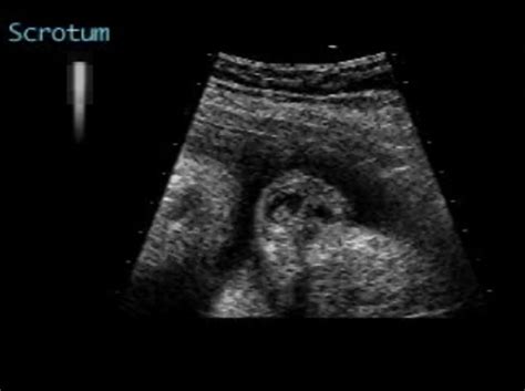 Hydrocele – Ultrasoundpaedia