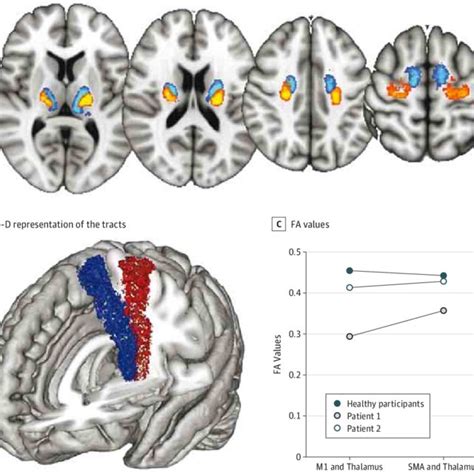 Summary Of The Diffusion Tensor Imaging Tractography Results Download
