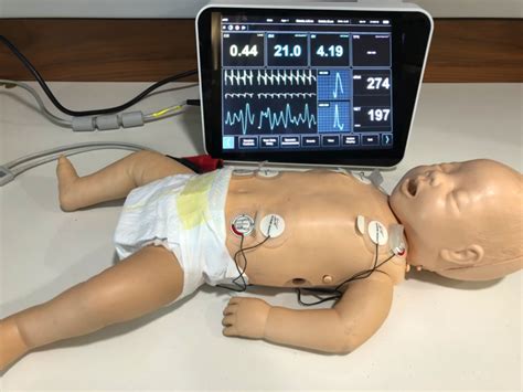 Feasibility Of Non Invasive Cardiac Output Monitoring At Birth Using