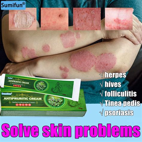 20g Skin Psoriasis Herbs Anti Inching Antibacterial Cream Dermatitis