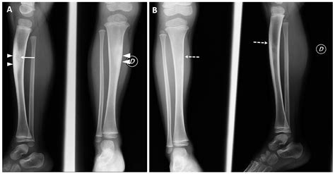 Ct Guided Radiofrequency Thermal Ablation For The Treatment Of Atypical