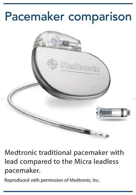 Leadless Pacemakers A New Technology In Cardiac Pacing American Nurse