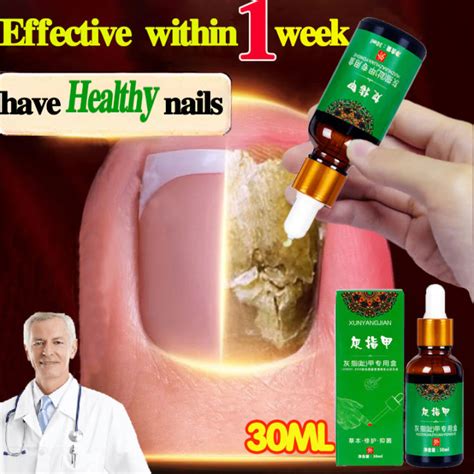 100 Effective Nail Fungus Treatment 30ml Remove Onychomycosis Nail