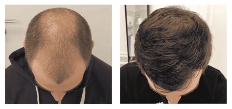 Male Patient 2500 Grafts Fue Procedure
