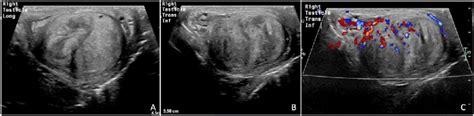Ultrasound Of The Right Testicle A Long View Of Heterogeneous