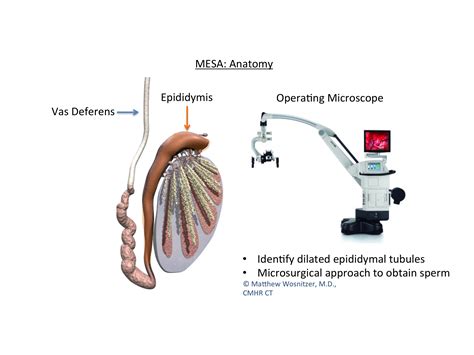 Microsurgical Epididymal Sperm Aspiration – Center For Male Health