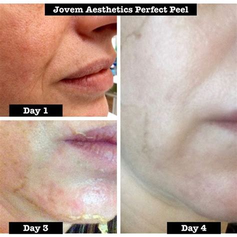 Jovem Aesthetics Perfect Peel Clients Own Photos Taken On Day 3 And 4