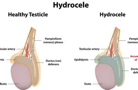 Hydrocele Testis Treatment Surgery In India Cost Hospitals And Doctor