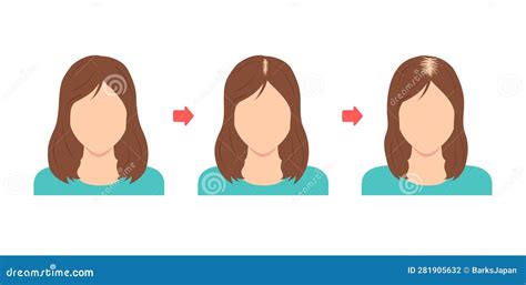 Progress Of Female Androgenetic Alopecia Illustration Stock Vector