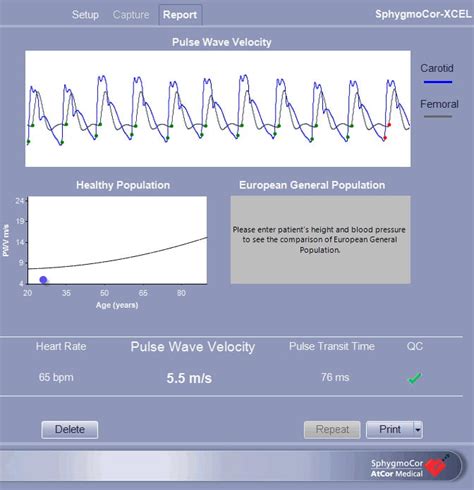 Pulse Wave Analysis And Velocity Human Neural Cardiovascular Control Lab The University Of