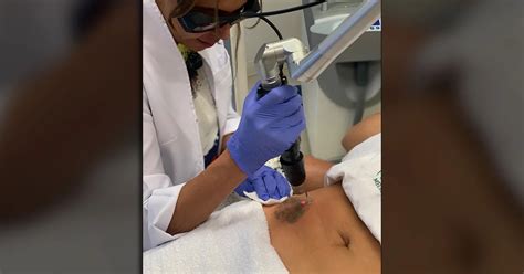 Borrar Los Tatuajes Es Posible Cómo Es La Nueva Tecnología Que Permite